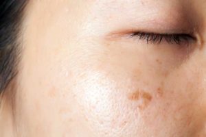 Taches pigmentaires et de l'hyperpigmentation - Dr Fournier à Montpellier